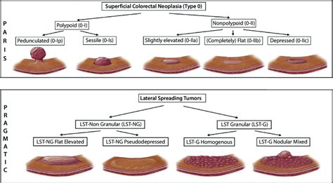 Paris And Pragmatic Classifications Of The Superficial Colorectal