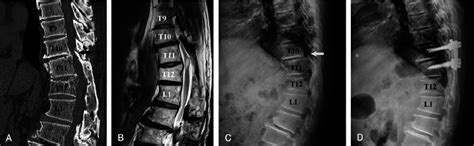 A 66 Year Old Man Had Thoracic Myelopathy T10 11 By Ossification Of