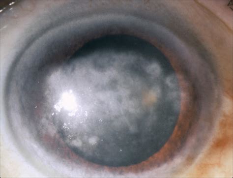 Interstitial Keratitis Salmon Patch