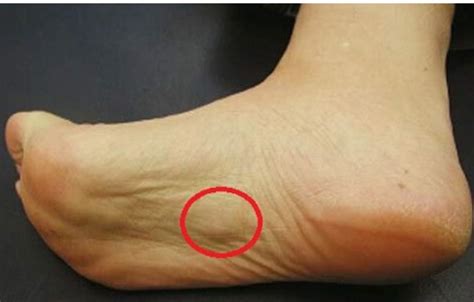 足底筋膜纖維瘤 Plantar Fibromatosis Jimmy 醫師部落格