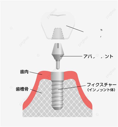 Dental Implant Flat Vector Illustration Jaw Dent Implants Vector Jaw