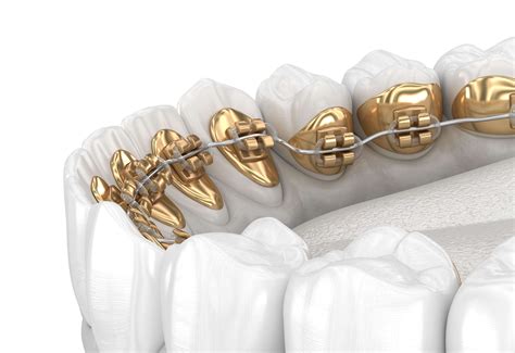Mission Viejo Lingual Braces South Oc Orthodontics