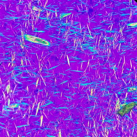 Body Fluid Crystals Identification And Clinical Significance