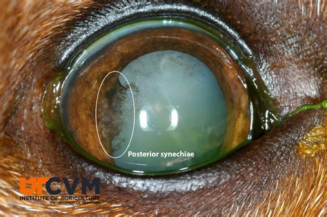 Anterior Vs Posterior Synechiae