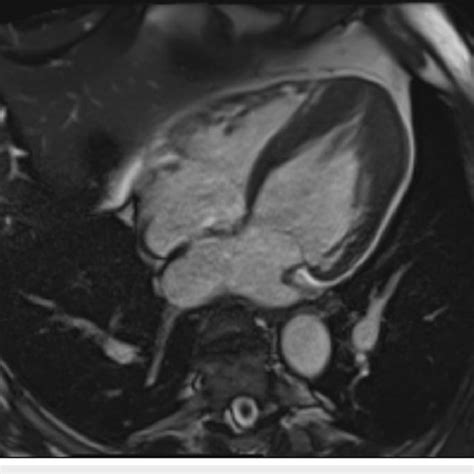 Cine Cardiac Mri Showing Severe Apical Hypertrophy With A Maximum
