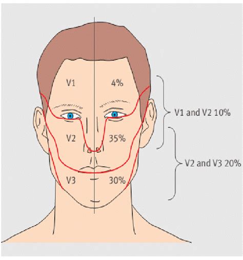 Trigeminal Neuralgia Neuropedia