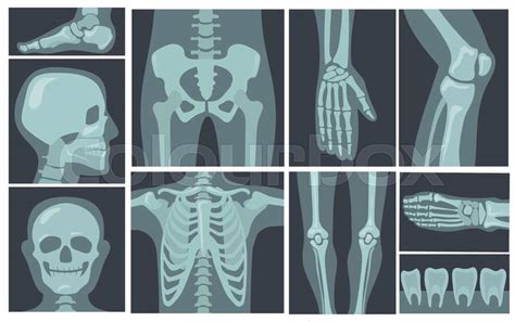 X Ray Human Body X Ray Information Mount Sinai New York