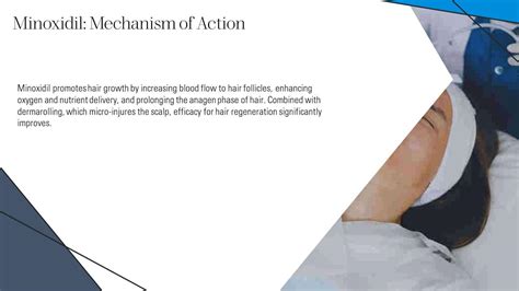 Dermaroller Com Minoxidil Ppt Outline Acp Ppt Example