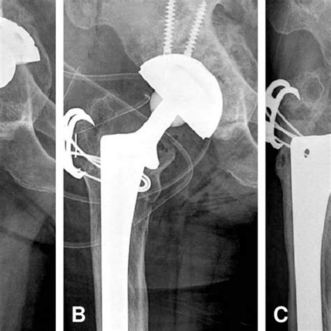 The Aaos Classification System For Acetabular Deficiencies Download Table