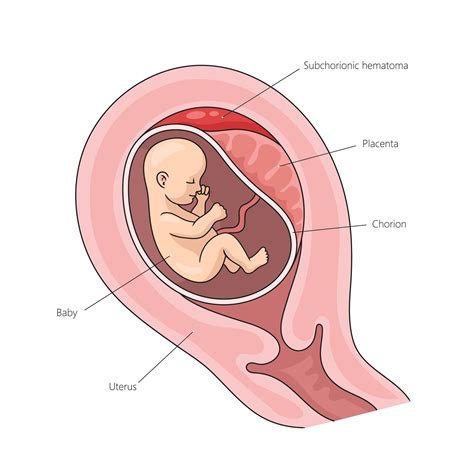 Placental Abruption Symptoms