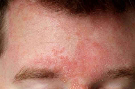 Perawatan Dermatitis Seboroik Id