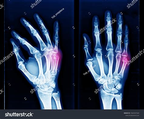 Metacarpal Neck