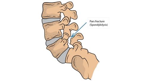 Stress Fractures Pars Stress Fractures Spine Surgeon Adr Vs Fusion