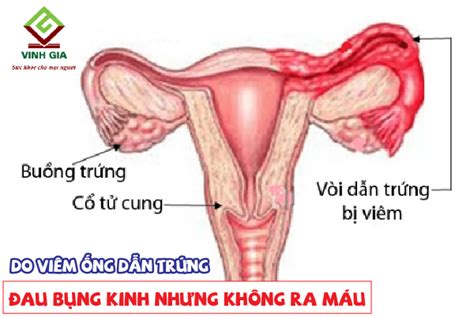 Đau bụng kinh nhưng không ra máu Khắc phục thế nào