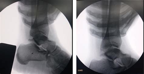 Radiologic Anterior Drawer Test Note Forward Talar Displacement In The Download Scientific