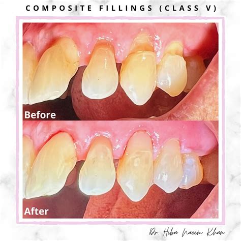 Dr Class V Aesthetic Fillings 😍 Dentalclinic Dentista Dentist