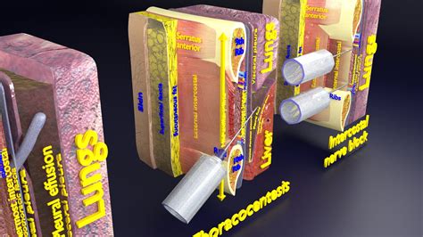 Thorax Thoracotomy Thoracocentesis Intercostal Nerve Block 3d Model Superhive Formerly