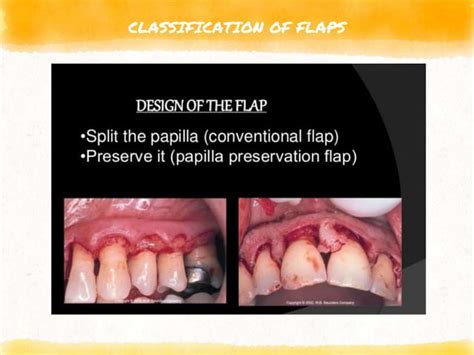 Periodontal Flap Surgery Pptx Dental Health Diseases And Conditions