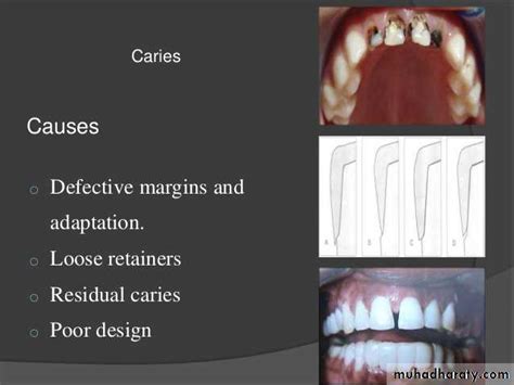 Failure In Crown And Bridge Pptx Dr Manaf Muhadharaty