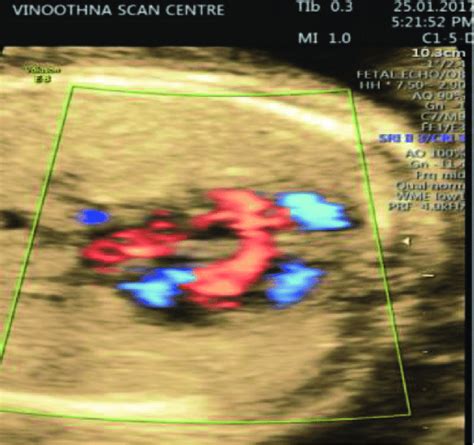 Small Membranous Vsd Download Scientific Diagram