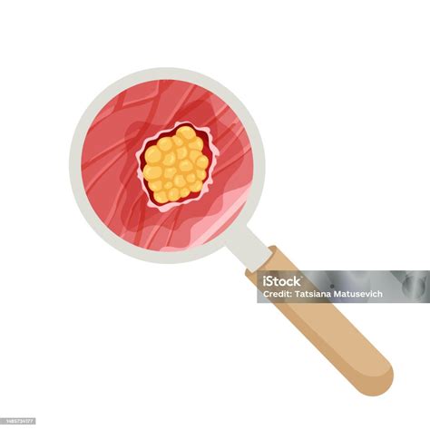 암 악성 암성 종양이 돋보기 아래에서 확대되었습니다 해부학적 벡터 삽화 격리된 흰색 배경 만화 스타일 간 내부 기관에 대한 스톡 벡터 아트 및 기타 이미지 Istock