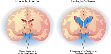 Stages Of Huntingtons Disease Huntingtons Disease Diseases Club