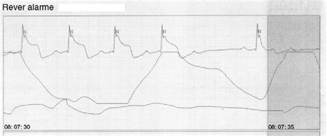Ecg Trace Showing Angina Associated With Transient St Segment Elevation Download Scientific