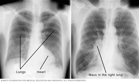 X Ray Imaging Test Quickly Helps Find Diagnosis Mayo Clinic