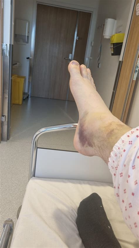 3 Fractures 1 Ankle Give Me Your Worst R Neverbrokeabone