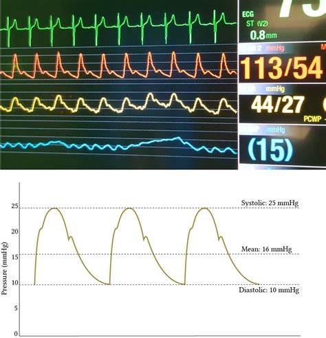 Pulmonary Artery Catheter Waveforms Pulmonary Artery Catheter Waveforms