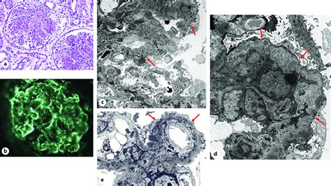 Diffuse Proliferative Ln Isnrps Class 4 A Two Glomeruli Display