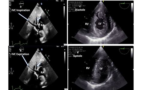 A TTE Sagittal View Of IVC Long Axis During Inspiration B IVC During Download Scientific
