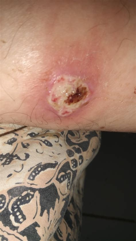 Luka Pada Betis Hellosehat