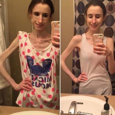 45 ‘before And After Photos Of People Who Beat Anorexia True Activist