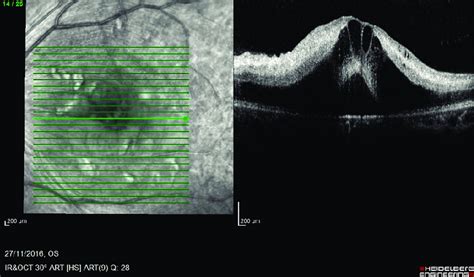Left Eye Oct Showed Presence Of Intraretinal And Subretinal Fluid Download Scientific Diagram