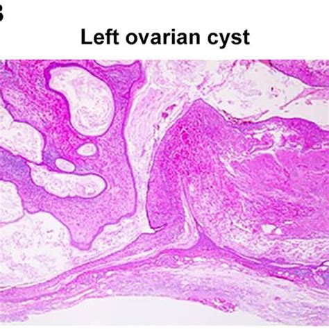 Pathological Findings Right Ovarian Cyst A Left Ovarian Cyst B Download Scientific