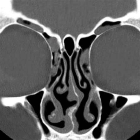 A Caldwell Radiograph Showing Opacification Of Frontal And Ethmoidal Download Scientific