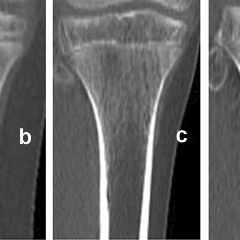 The Process Of Proximal Humeral Epiphyseal Fusion Based On Mckern And Download Scientific