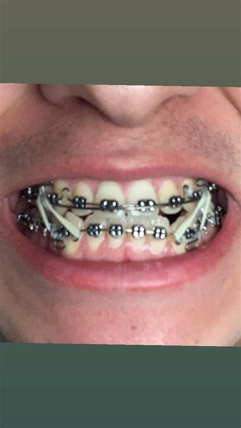 Amazing Non Surgical Underbite Correction Braces 1 Year Rbraces