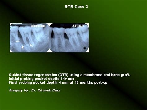 Guided Tissue Regeneration And Guided Bone Regeneration Guided