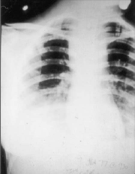 Pneumonic Plague Lungs