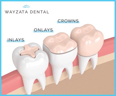 Dental Inlays Vs Onlays Do You Need Them Pros And Cons