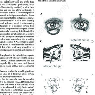 Pdf Apogeotropic Posterior Semicircular Canal Benign Paroxysmal