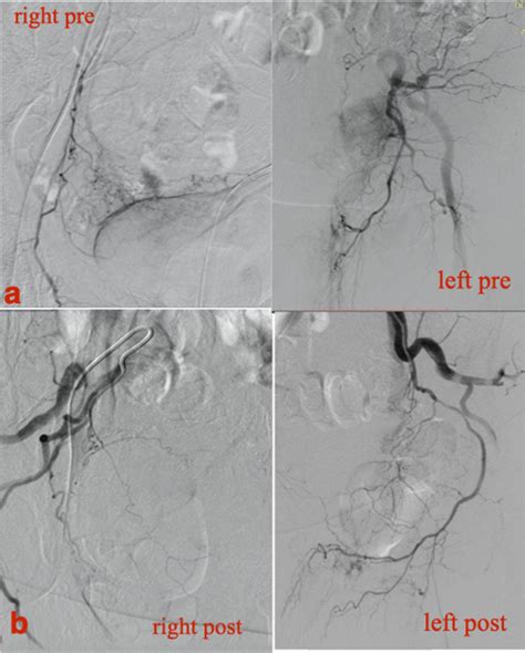 Embolization Of Urinary Bladder For The Treatment Of Intractable