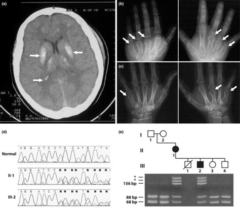 Pseudohypoparathyroidism Type 1a Due To A Novel Mutation In The Gnas Gene Pmc