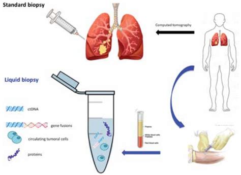 Standard Biopsy Versus Liquid Biopsy The Figure Illustrates