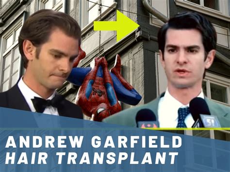 Andrew Garfield Hair Transplant Hair Loss And Technical Analysis