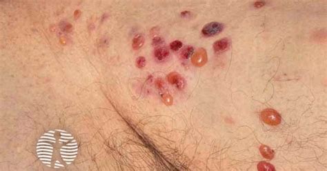 Bullous Pemphigoid Image