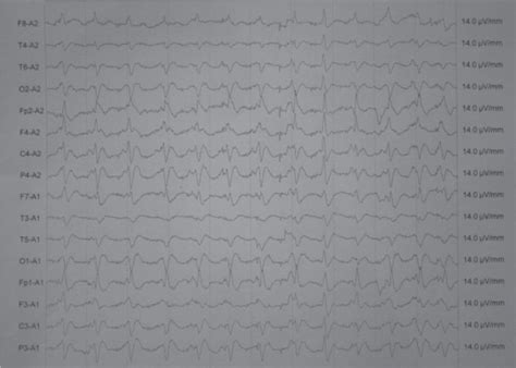 Electroencephalography Eeg Shows Mid Positive Triphasic Waves Download Scientific Diagram Electroencephalography Eeg Shows Mid Positive Triphasic Waves Download Scientific Diagram