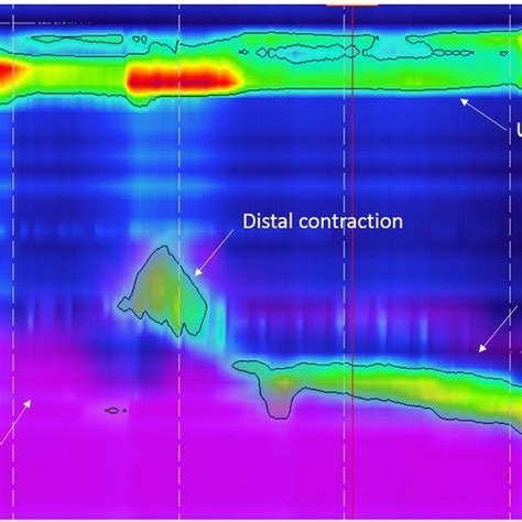 The 5 Parameters In High Resolution Manometry Analysis Ues Pr Upper